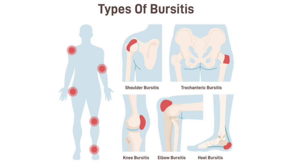 Understanding Bursitis: Causes, Symptoms, and Prevention - Pilates Centre